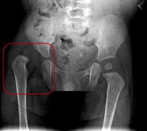 Infant Diagnosis - International Hip Dysplasia Institute