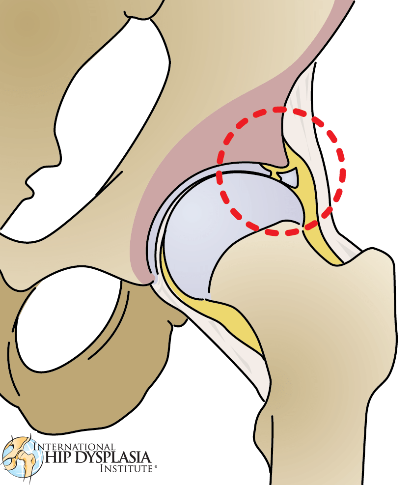Torn Labrum - International Hip Dysplasia Institute