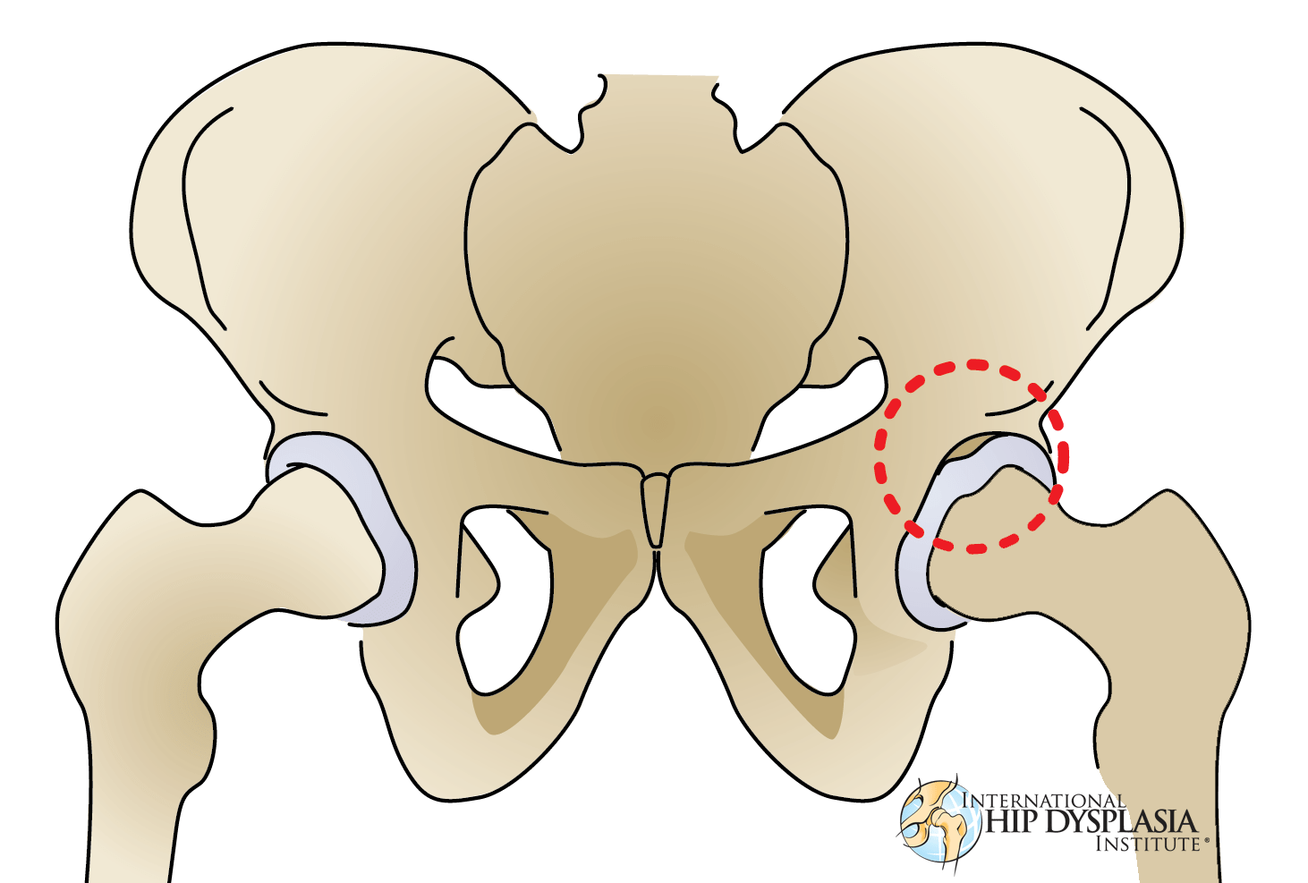 Torn Labrum - International Hip Dysplasia Institute