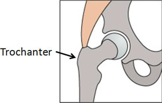 Trochanteric Bursitis - International Hip Dysplasia Institute