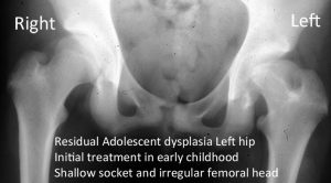 Adolescents - International Hip Dysplasia Institute